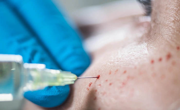 Advanced PRP Face & Hair Training | SkinLab Medical Academy